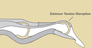 Extensor Tendon Injury: Signs & Treatment | The Hand Society