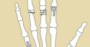 Broken Hand: Symptoms and Treatment | The Hand Society