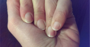 Boxers Fracture: Signs and Symptoms | The Hand Society