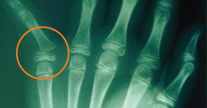 Fractures in Children: Risks & Treatment | The Hand Society