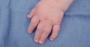 Congenital Hand Differences: What Is It? Symptoms, Causes, and ...