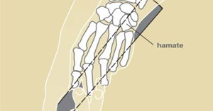 Golf Injuries: Prevention and Treatment | The Hand Society