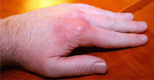 Pseudogout: Symptoms and Treatment | The Hand Society