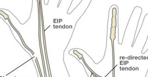Tendon Transfer Surgery: Risks & Benefits | The Hand Society