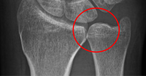 Ulnar Wrist Pain: Causes and Treatment | The Hand Society