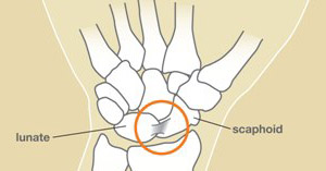 Sprained Wrist: Symptoms and Treatment | The Hand Society