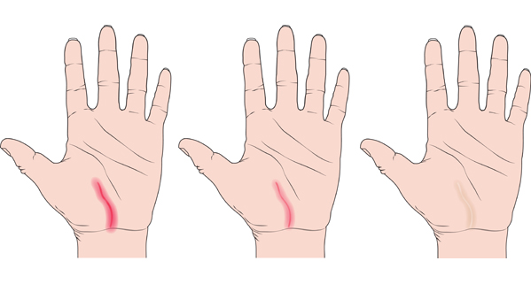 Advice from a CHT: Scar Management | The Hand Society