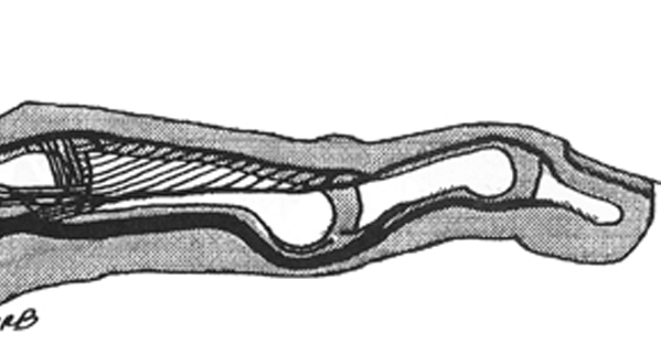 What is a Swan Neck Deformity? | The Hand Society