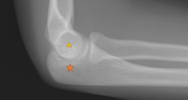 Elbow Dislocation: Signs and Treatment | The Hand Society