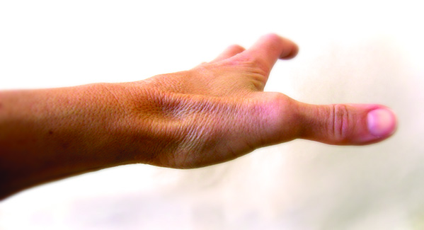Help for Thumb and Wrist Tendonitis | The Hand Society